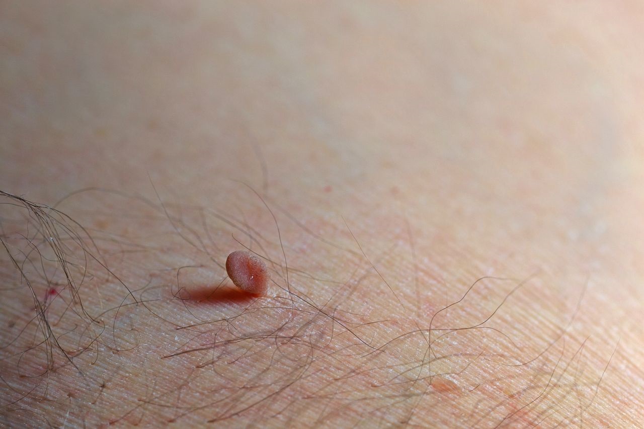 Skin Tags Removal | Skin and Cancer Associates