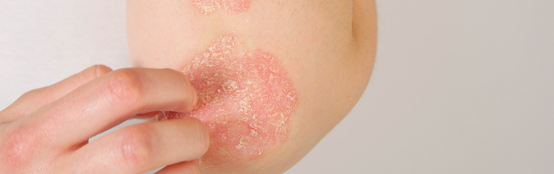 The Key Factors that Cause Psoriasis - Skin and Cancer Associates, Florida